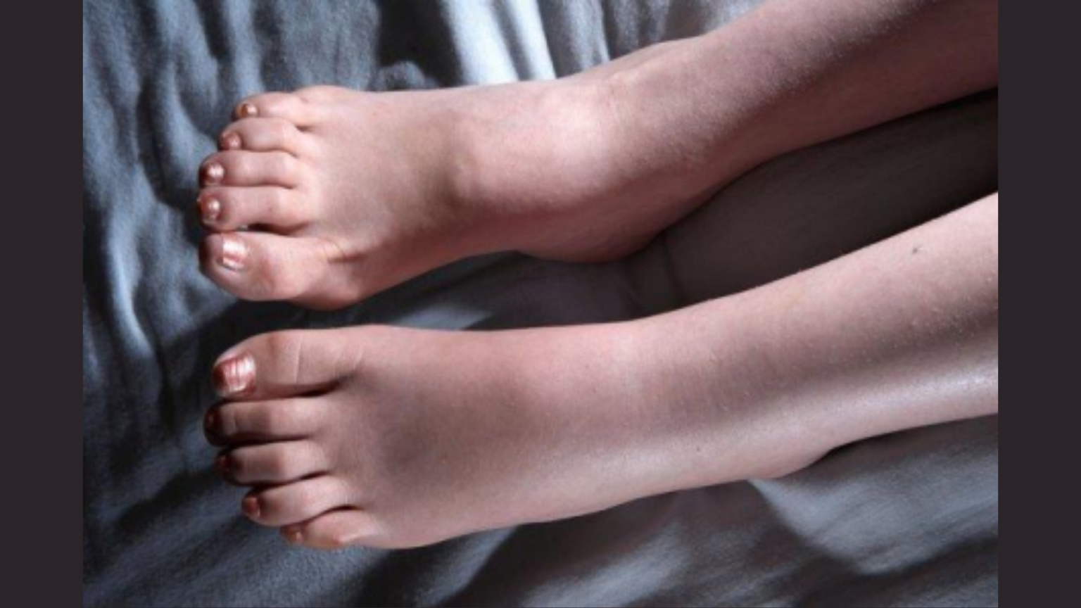 Catat, Berikut Cara Menentukan Derajat Pitting Edema - Blog